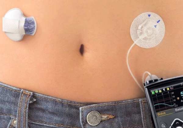 Medtronic MiniMed 780G | 6 Amazing Innovative Features