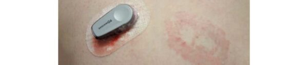 CGM Side Effects and How to Avoid Them - Not Just a Patch