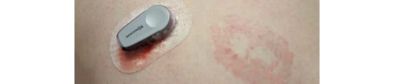 CGM Side Effects and How to Avoid Them - Not Just a Patch