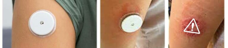 CGM Side Effects and How to Avoid Them - Not Just a Patch